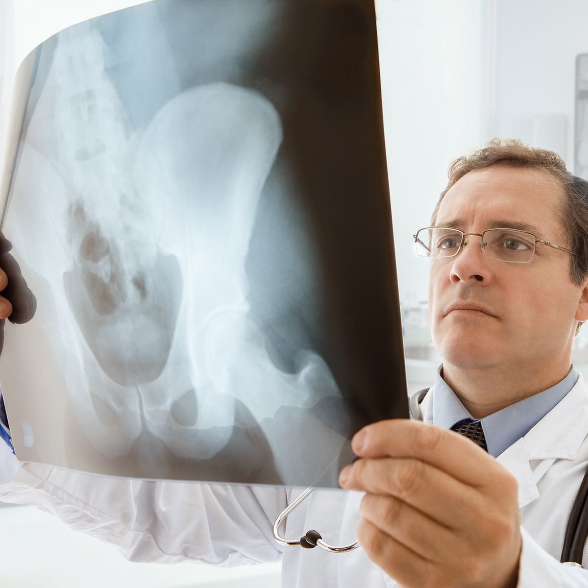 Coxarthrose (Hüftgelenksarthrose): Diagnose, Verlauf und Behandlung ...