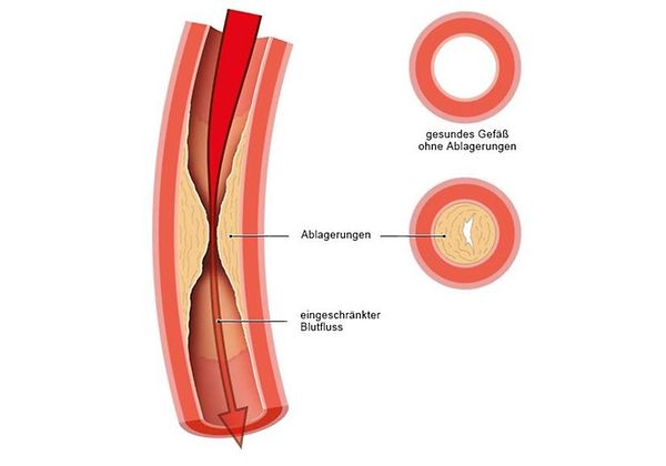 Periphere arterielle Verschlusskrankheit (PAVK) - Durchblutungsstörung ...