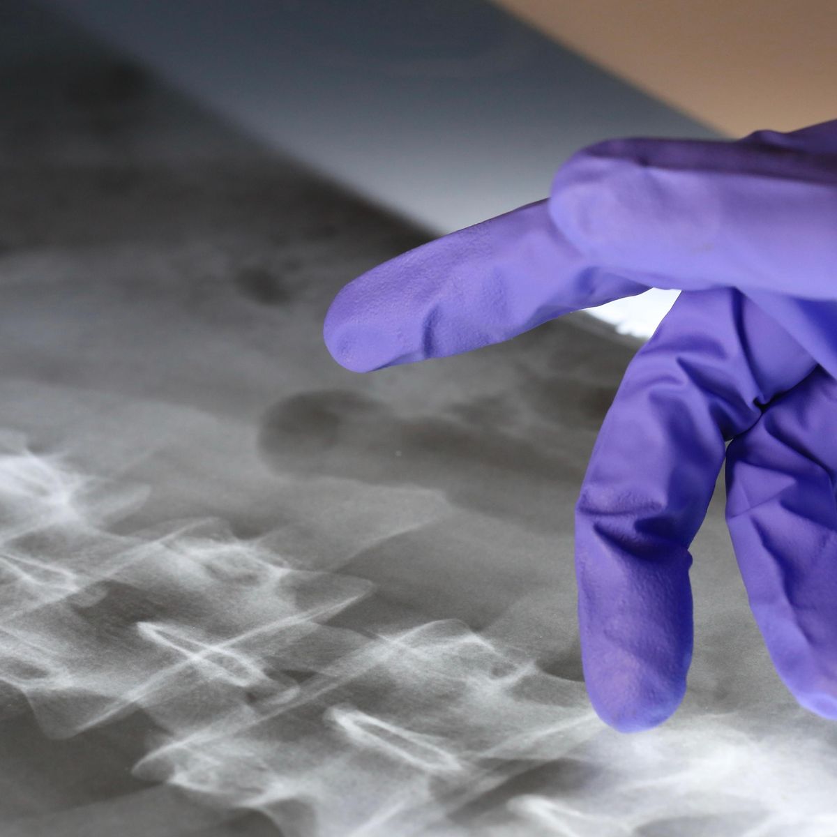 Spondylarthrose erkennen und behandeln: - Die Techniker